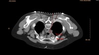 CT引导定位栅(医学图像体外定位贴 MK#CT)
