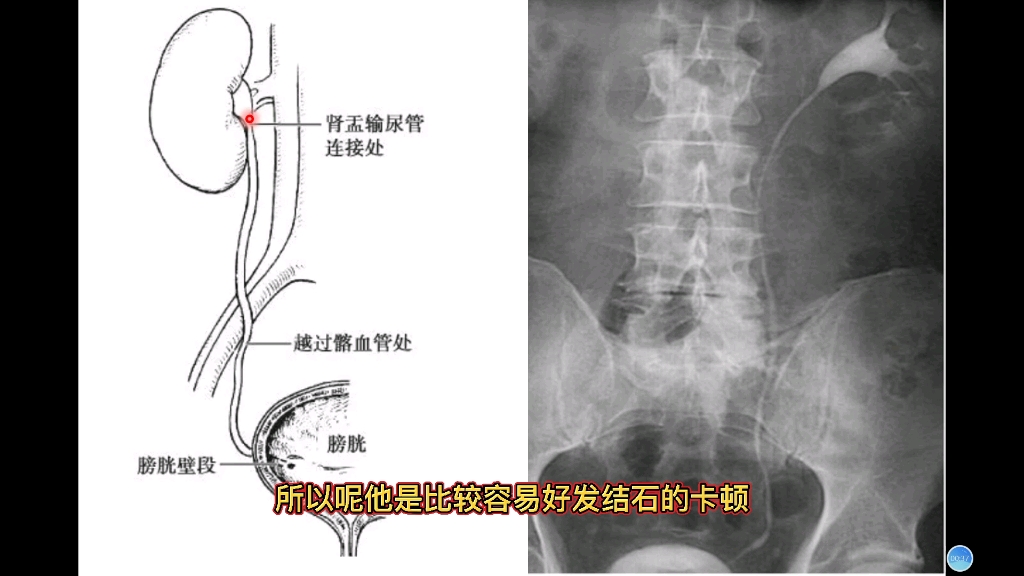 影像知识科普:输尿管三个生理性狭窄讲解,输尿管结石病例分享