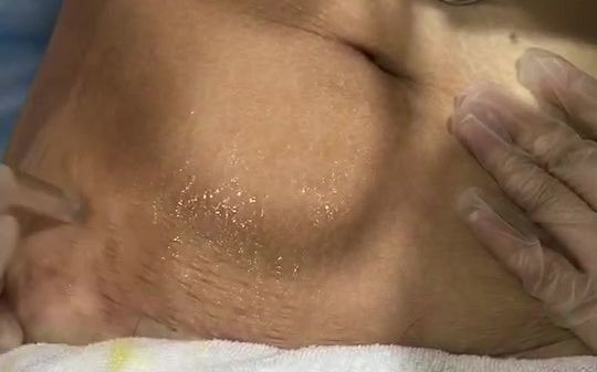 成都妊娠纹修复实拍,这位妈妈已经产后9年了,第一次修复淡化妊娠纹