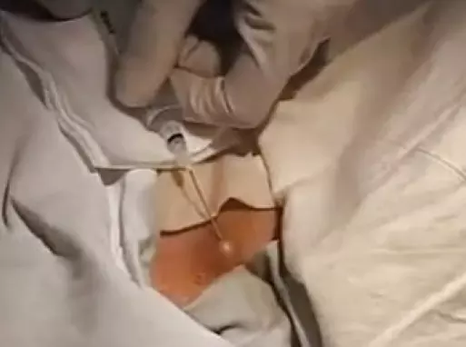 经皮气管切开术_标清