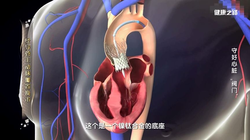 经导管主动脉瓣置换术