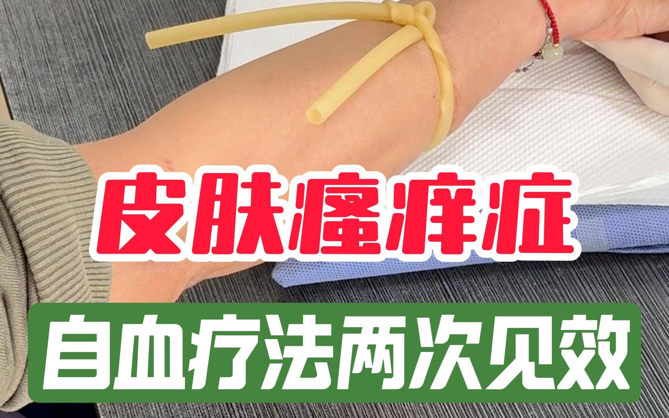 皮肤瘙痒症自血疗法两次见效