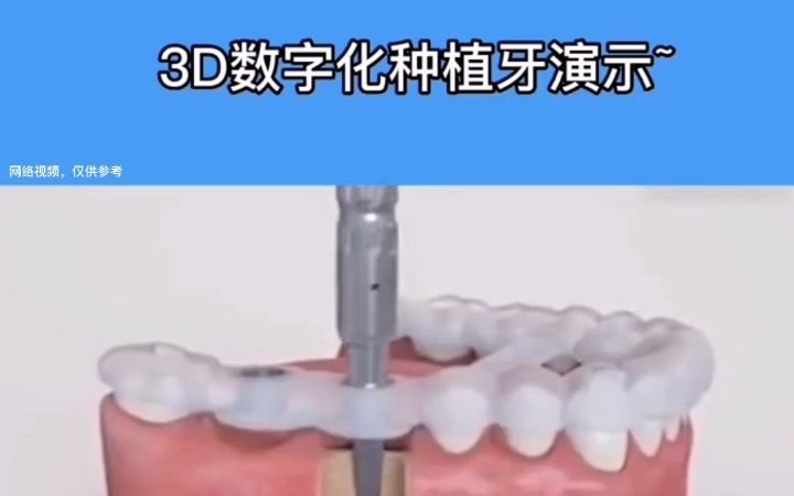 什么是数字化种植牙?看3D动画演示