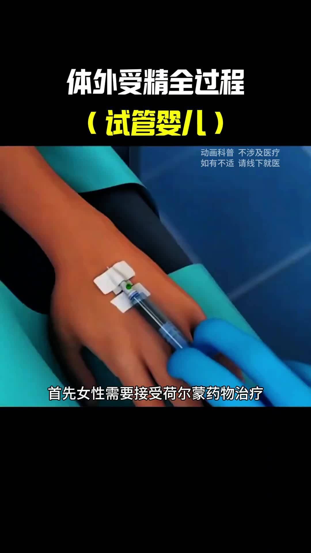 体外受精全过程,试管婴儿是如何产生的