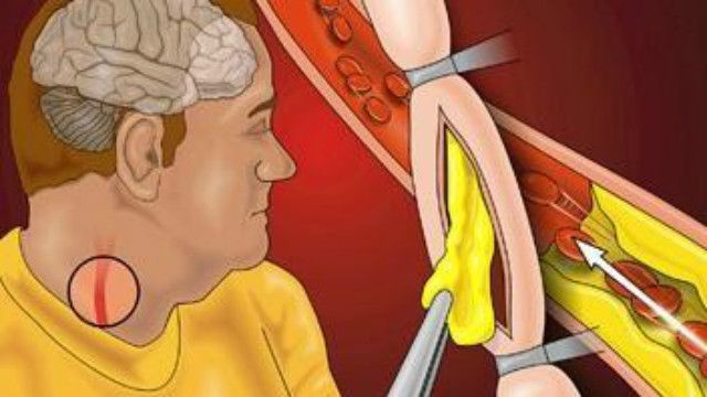 连接大脑血管堵塞怎么办,食用一种食物可清理垃圾疏通血管