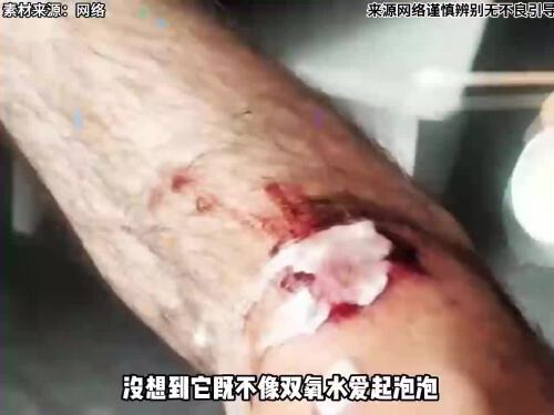 碘伏:杀菌界的隐形王者,表面青铜实则无敌战神