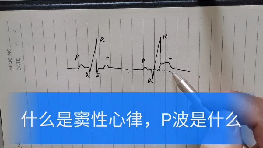 什么是窦性心律，P波是什么，ST段抬高型心梗跟心梗是什么关系