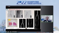 高涌-主动脉分叉覆膜支架治疗主髂动脉闭塞症