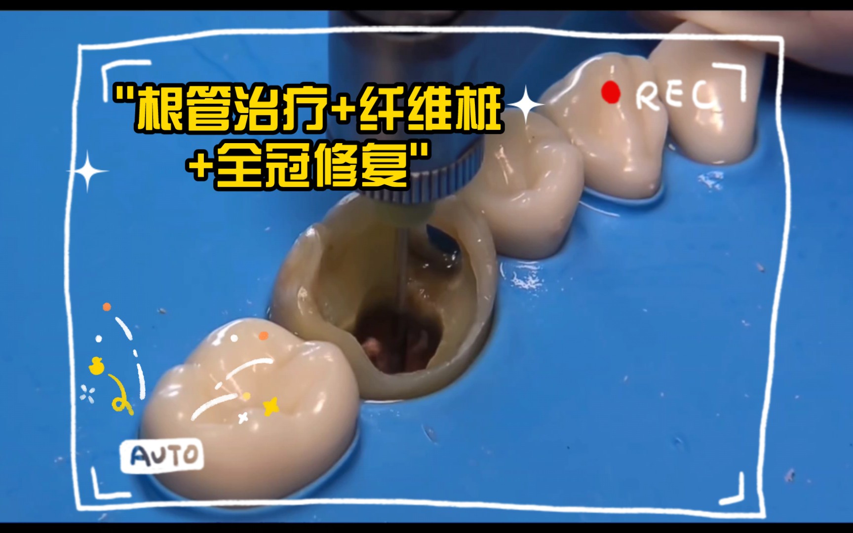 根管治疗+纤维桩+全冠修复