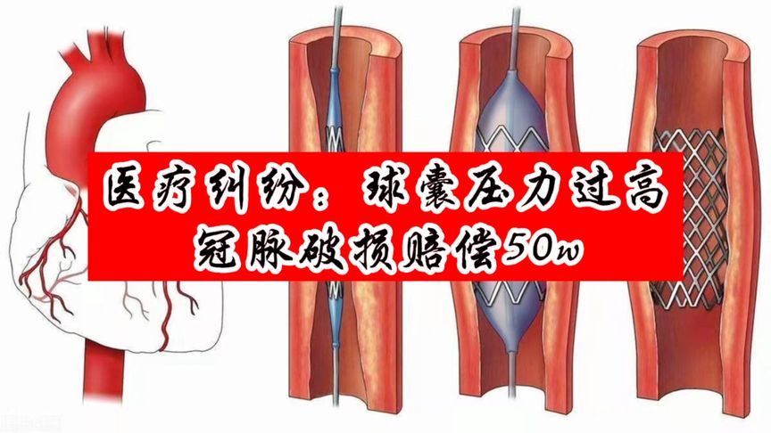 医疗纠纷:球囊压力过高,冠脉破损赔偿50w