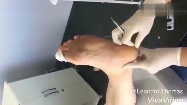 修脚,修老茧视频