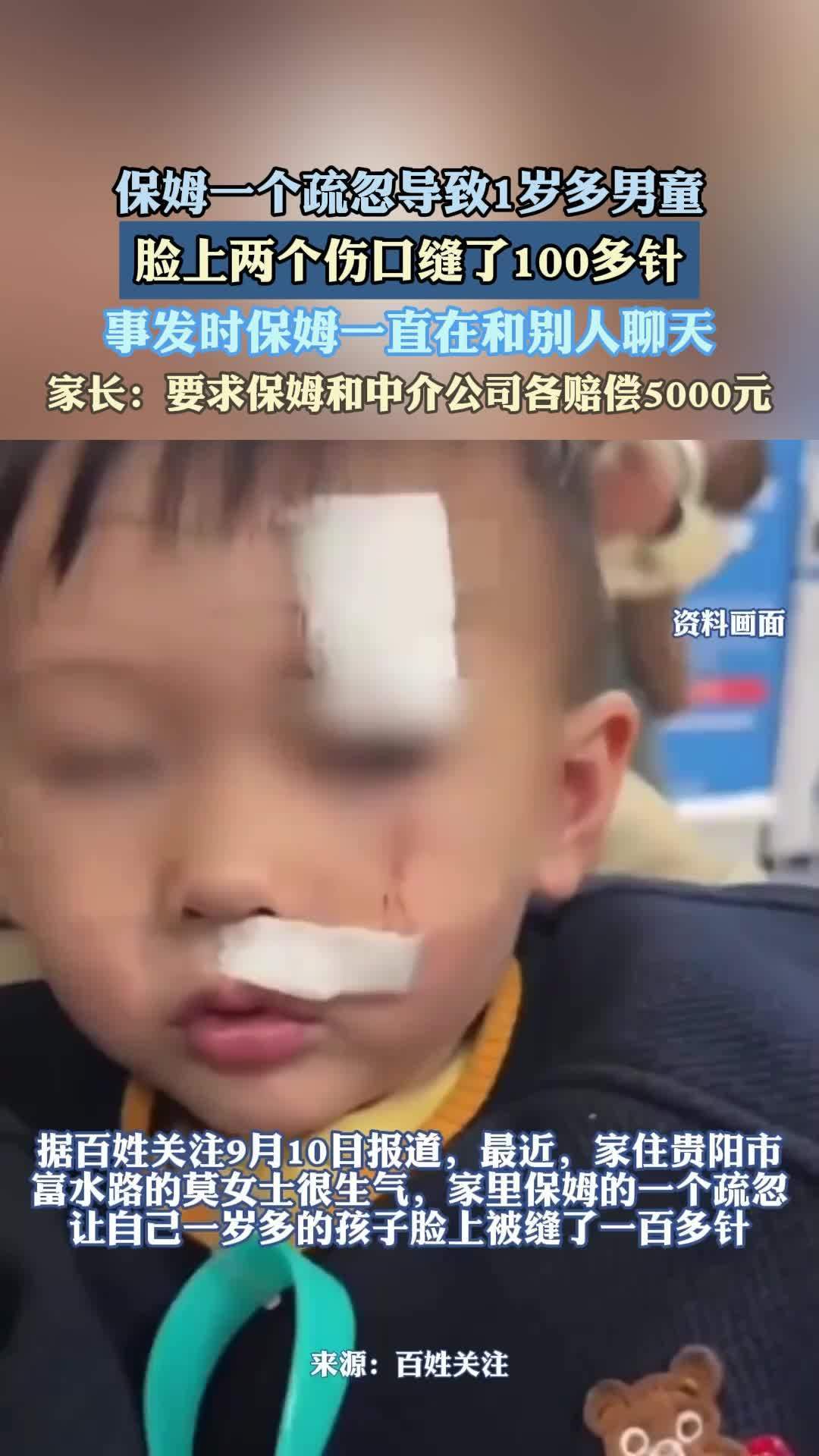 保姆一个疏忽,导致1岁多男童脸上两个伤口缝了100多针。