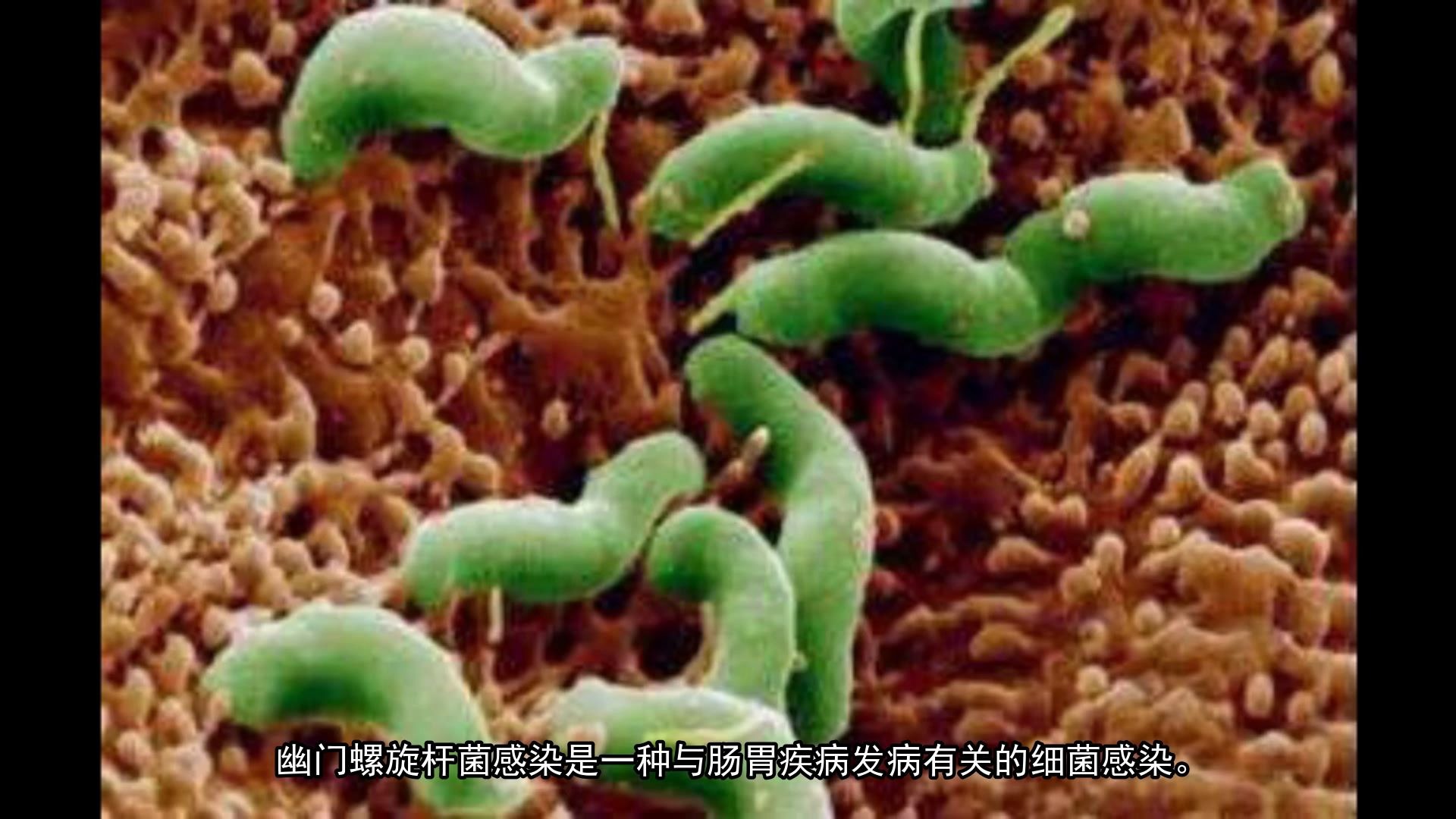 幽门螺旋杆菌科普