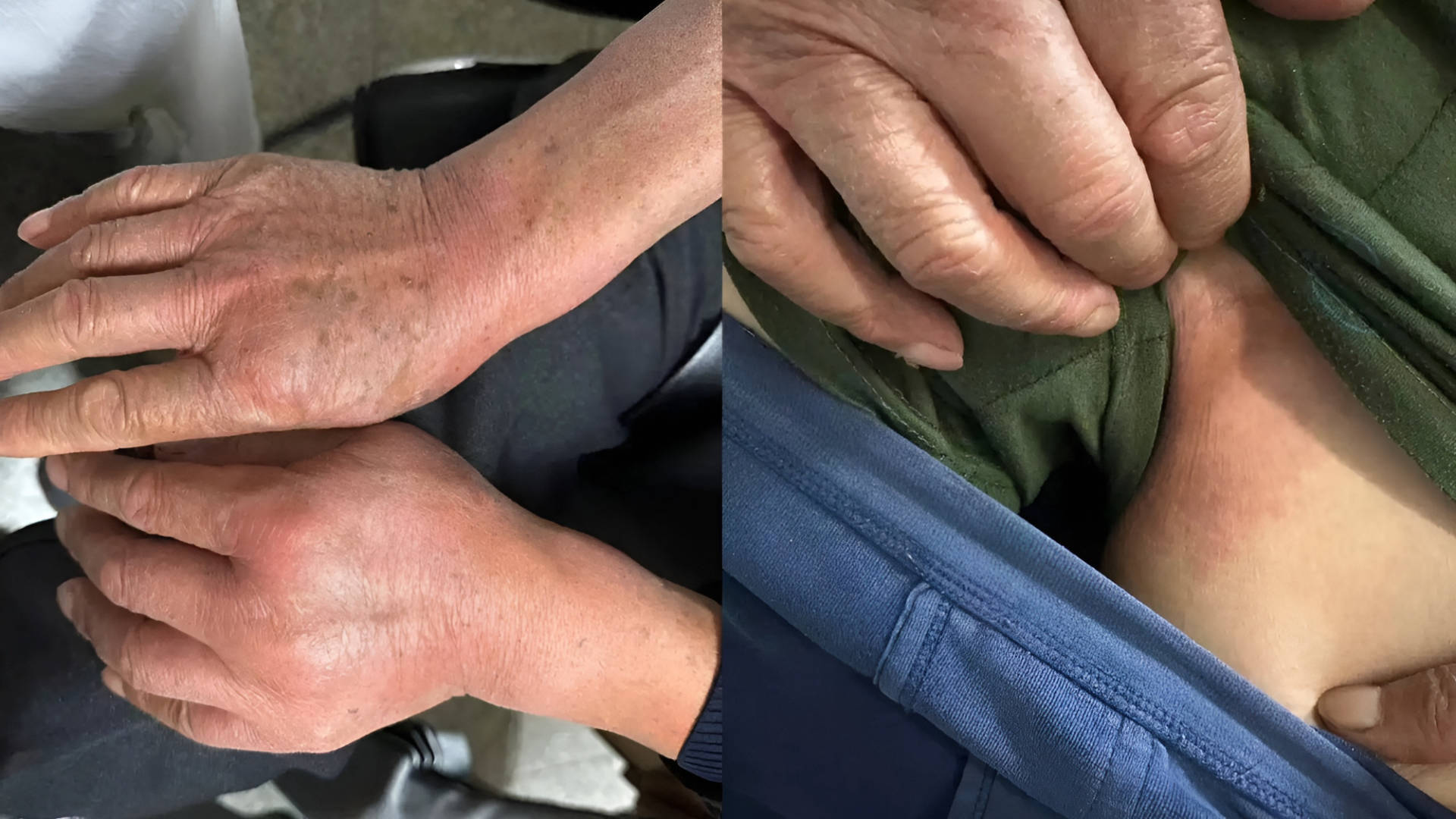 大爷被几百只蚂蚁围攻进抢救室:白细胞计数接近两万!元凶竟是院角那...