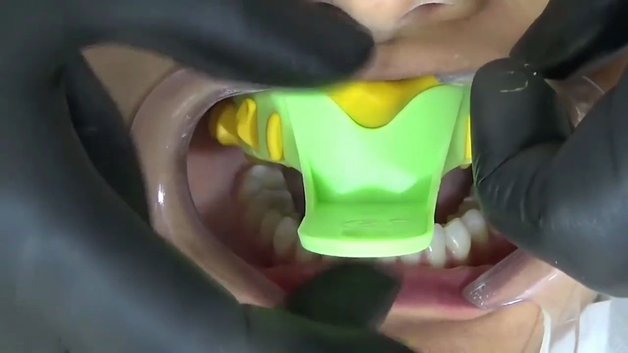 牙模是怎么做的?