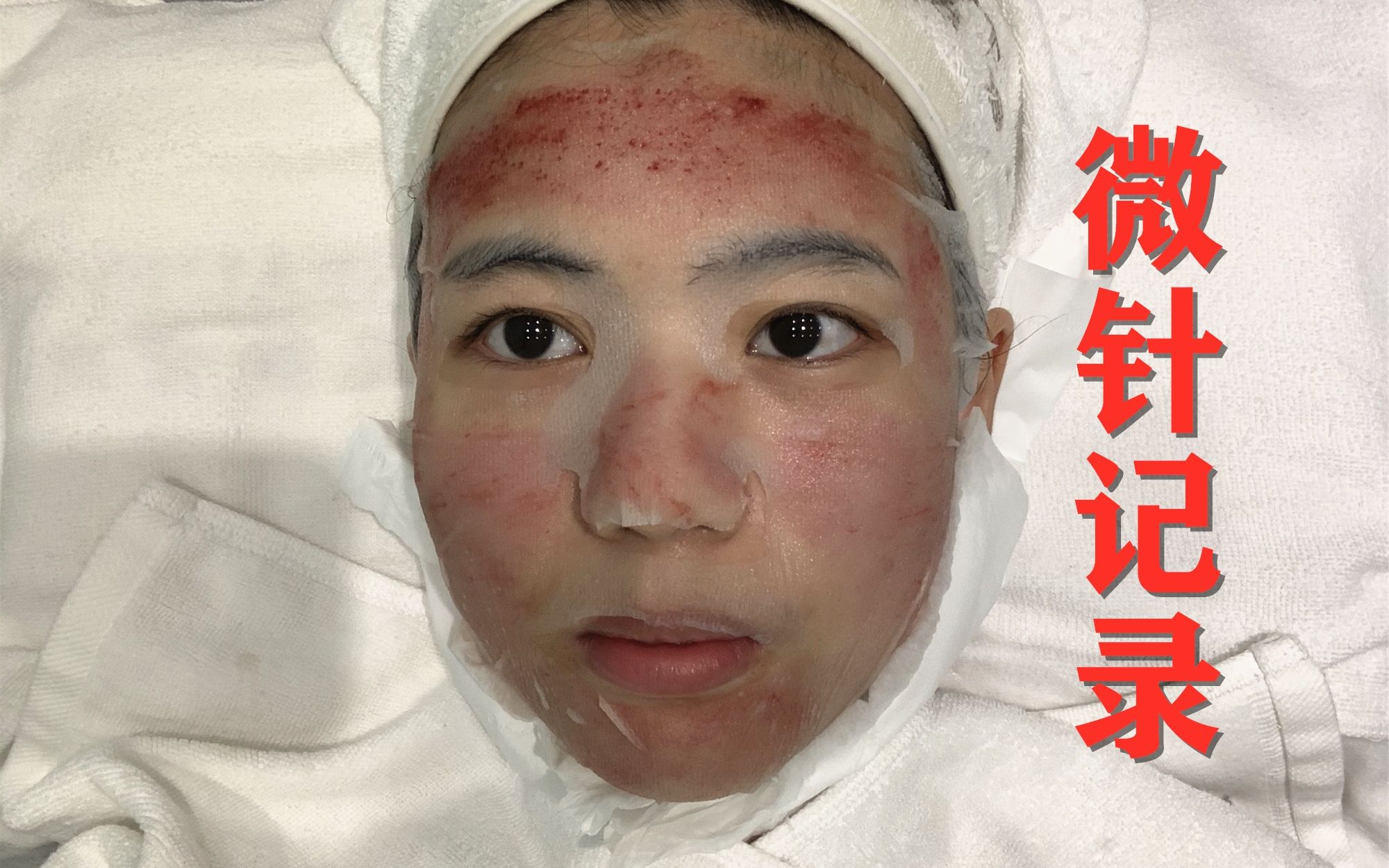 4天真实微针记录皮肤变化