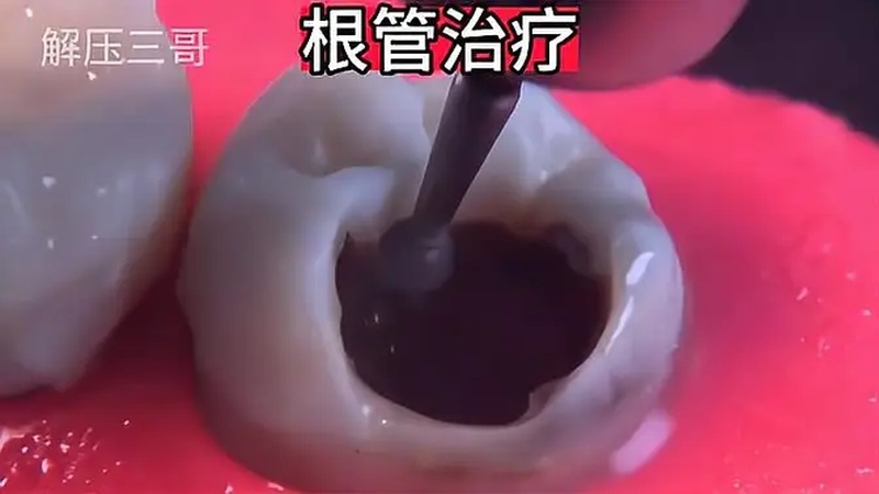 根管治疗,小洞不治,牙齿遭殃,早晚刷牙,从我做起 极度舒适
