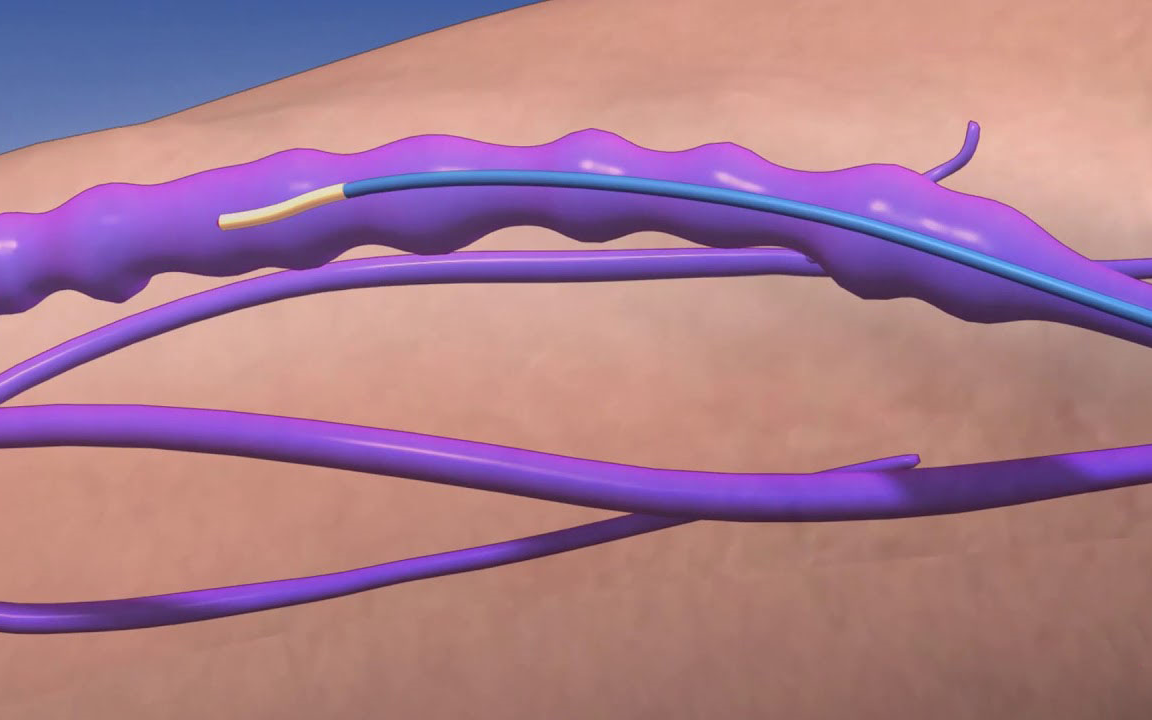3D动画:静脉内热消融术