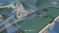 中国骨科耗材网 髓内钉(PFNA)操作演示