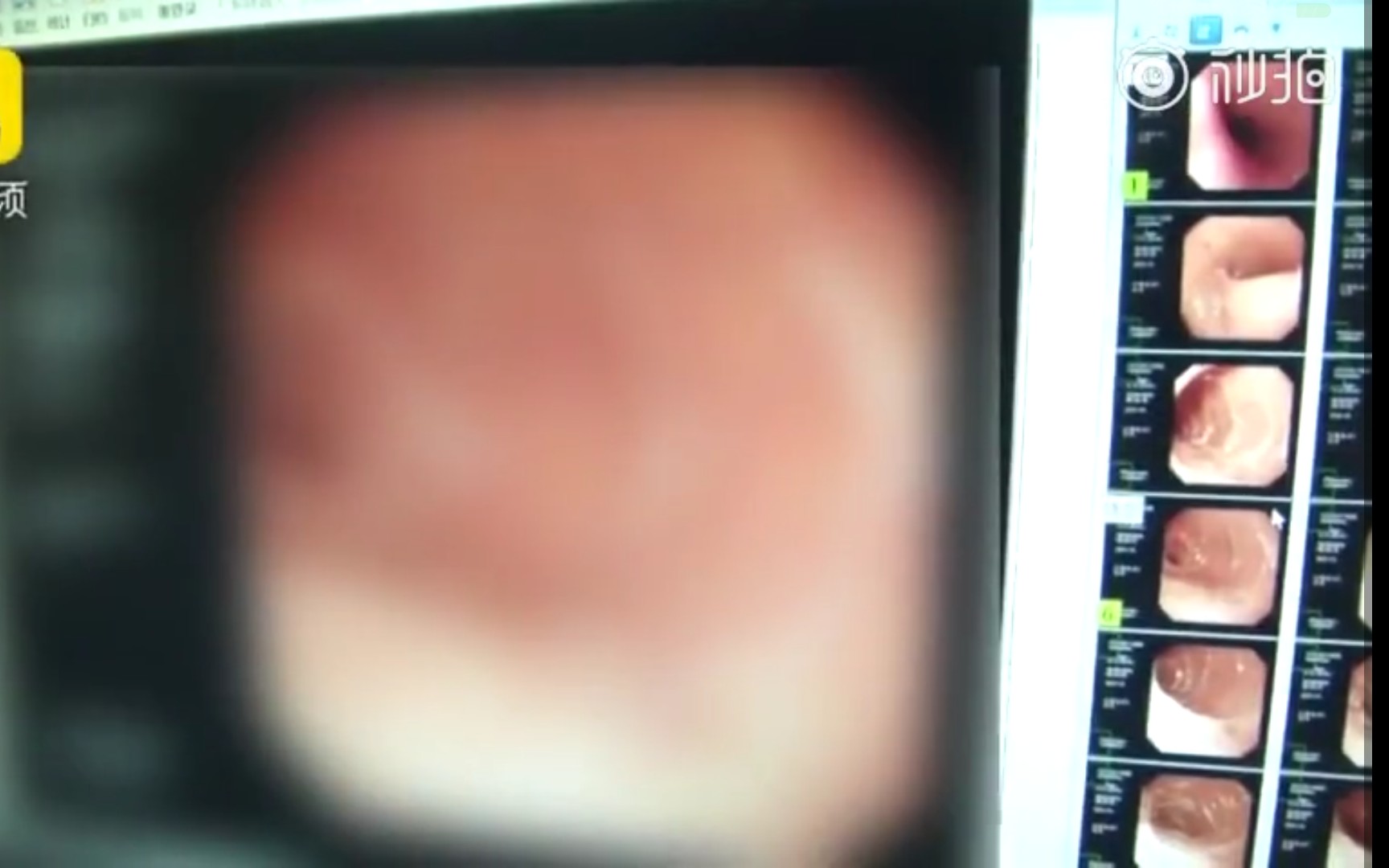 听信偏方!女子吞食一整瓶蛆虫治肺癌,一个月后还在肠道爬!