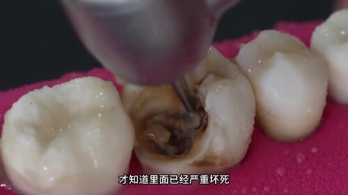 牙齿的根管治疗,简直是太解压了