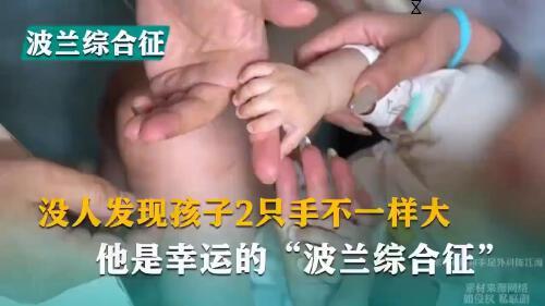 神奇!宝宝手大小不一,医生说不用手术!