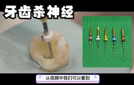 牙齿杀神经,根管治疗的全过程,既酸爽又解压~