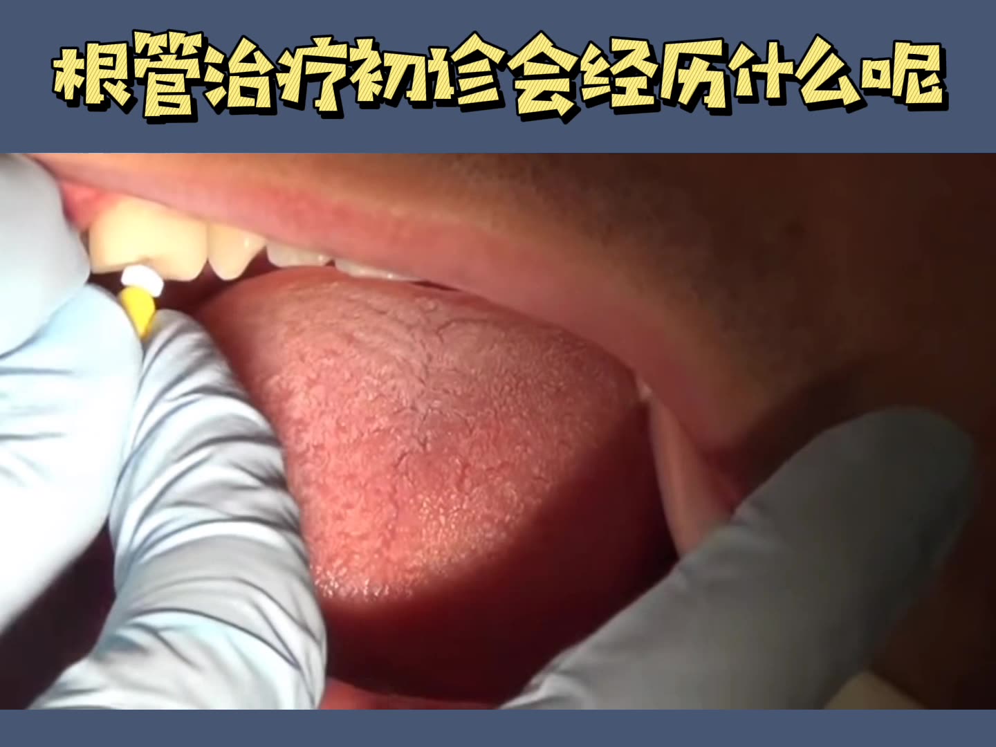 【深圳根管治疗】根管治疗初诊会经历什么呢?