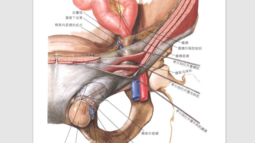 腹股沟疝 TAPP术病例(1)