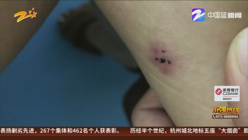 被狗咬伤之后(下):索赔650元 这个数目合理吗?