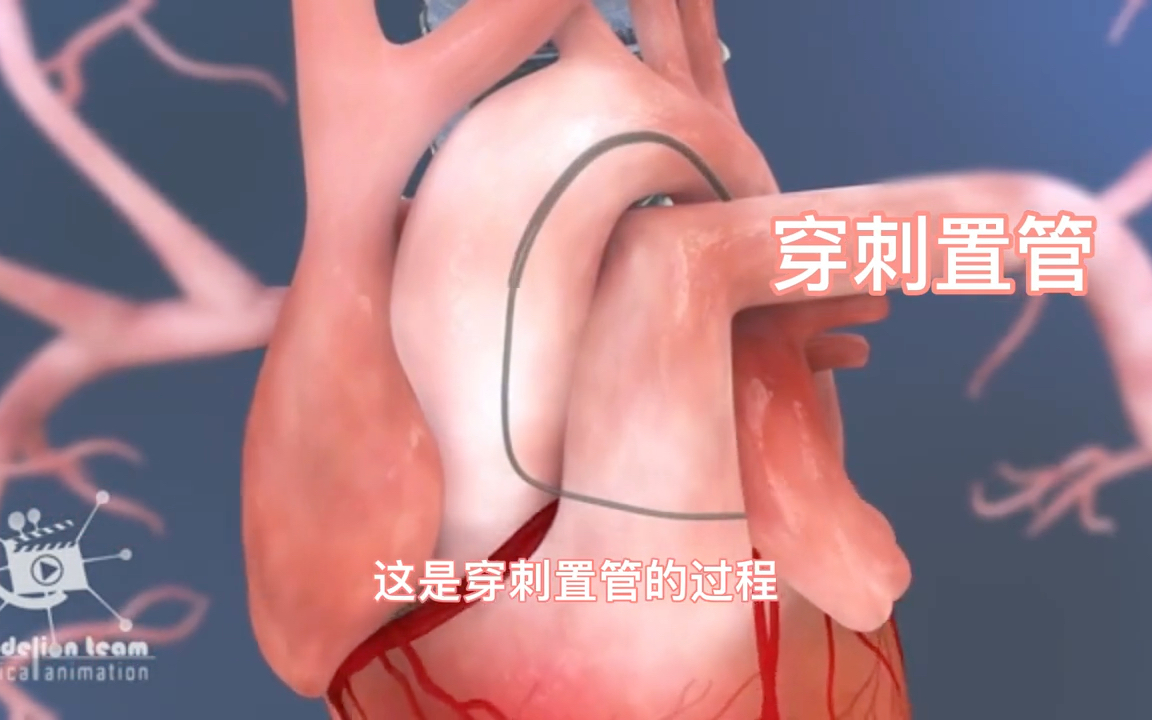 冠心病患者心脏支架置入过程动画演示,值得收藏!