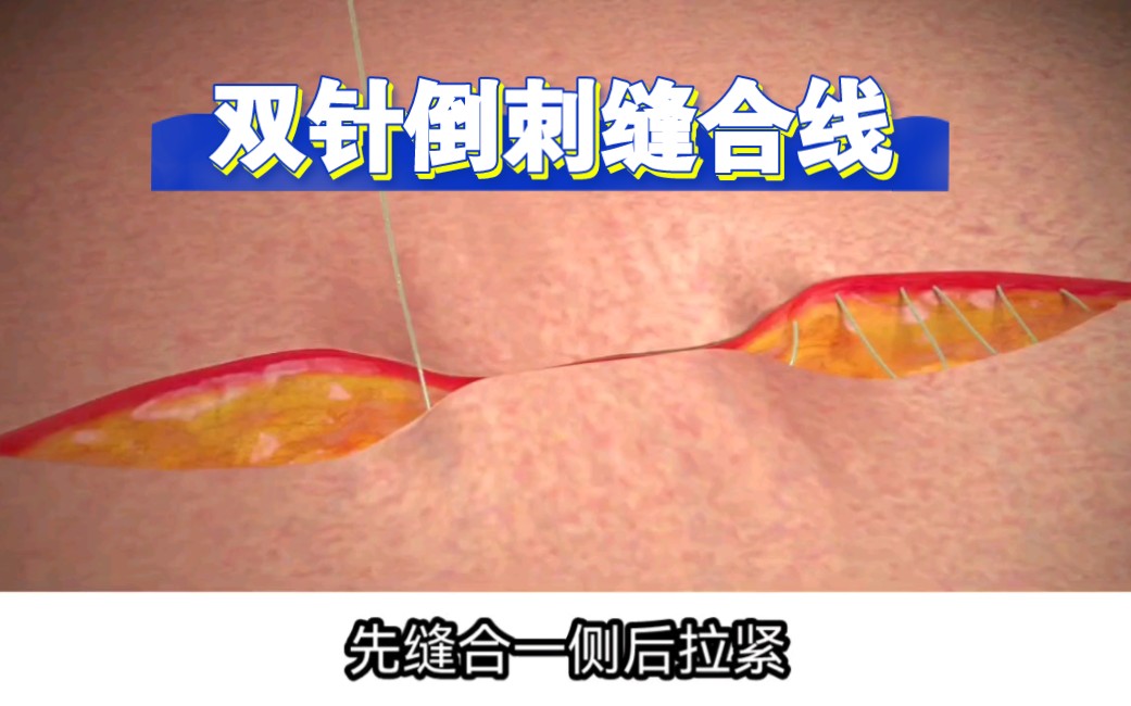 双针倒刺缝合线使用技巧
