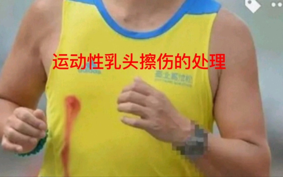 运动性乳头擦伤的处理