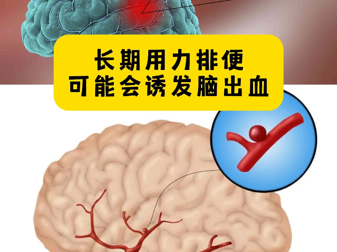长期用力排便可能会诱发脑出血