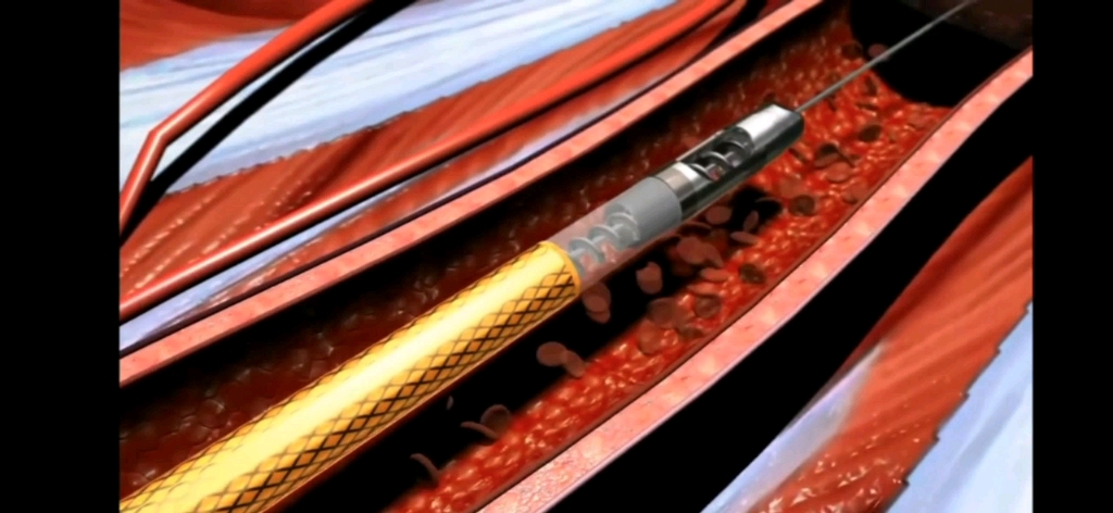 医学动画 带你真实体验心脏支架植入