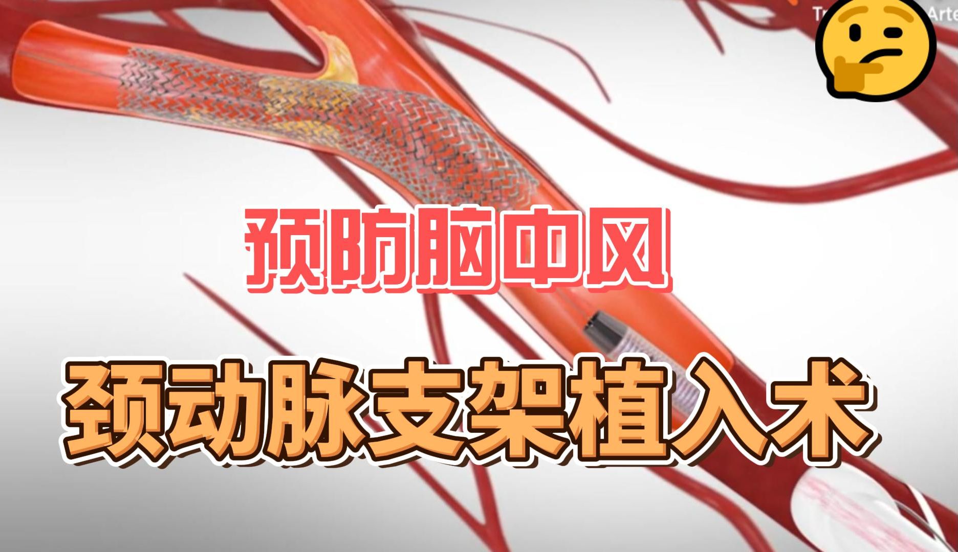 预防脑中风:颈动脉支架植入术