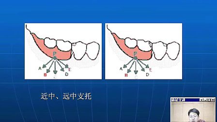 16.可摘局部义齿的组成和作用4