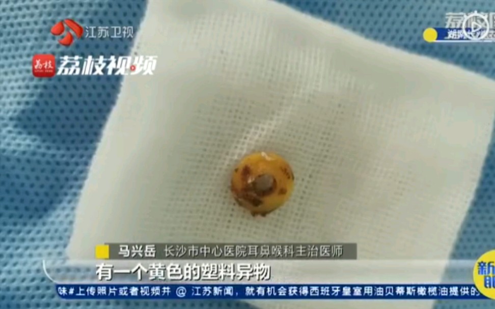 耳朵有硬物掏不动,医生从小伙耳内掏出藏了14年的算盘珠!