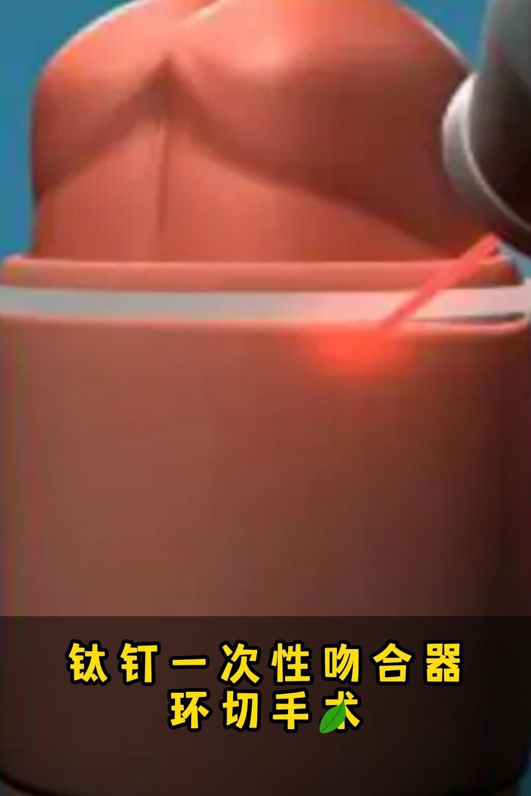 钛钉一次性吻合器环切手术