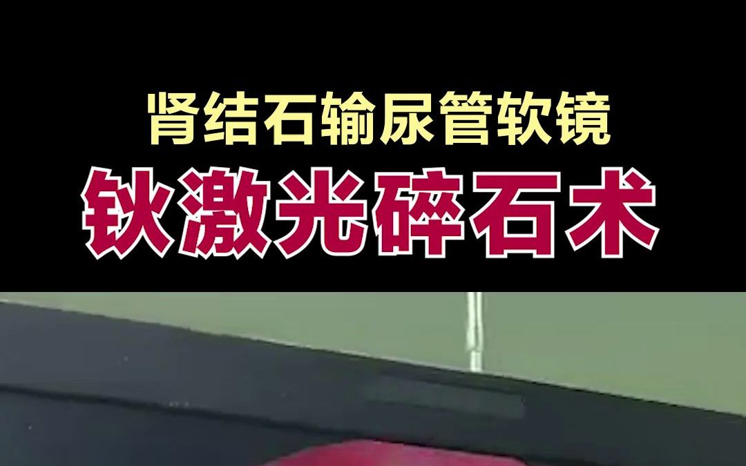 手术分享:肾结石输尿管软镜钬激光碎石术