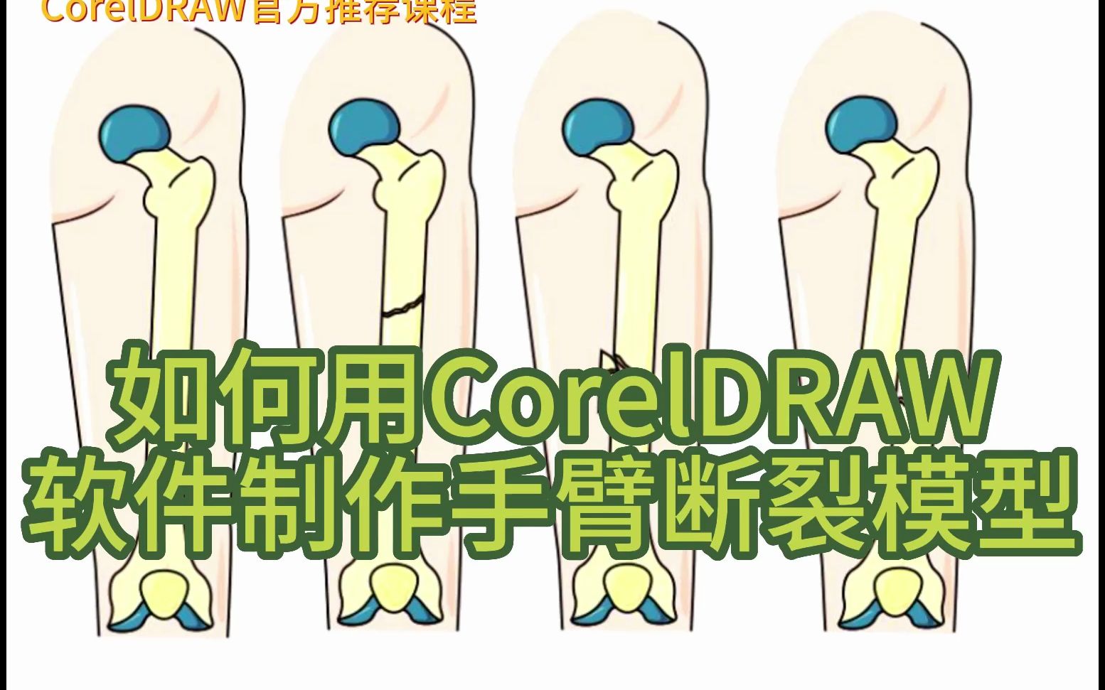 【SCI科研制图教程】如何用CorelDRAW软件制作手臂断裂模型(...