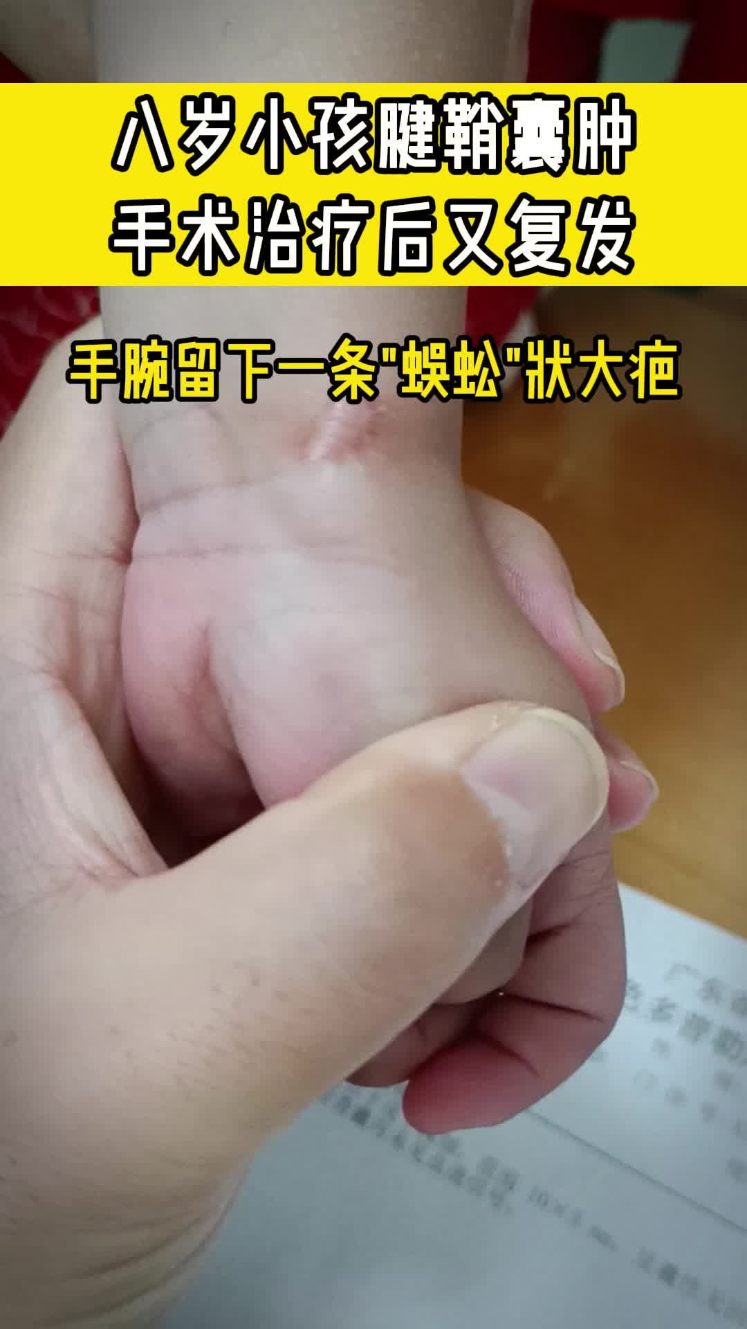 8岁孩童腱鞘囊肿手术后再次复发,为了不影响发育还得再次进行手术。...
