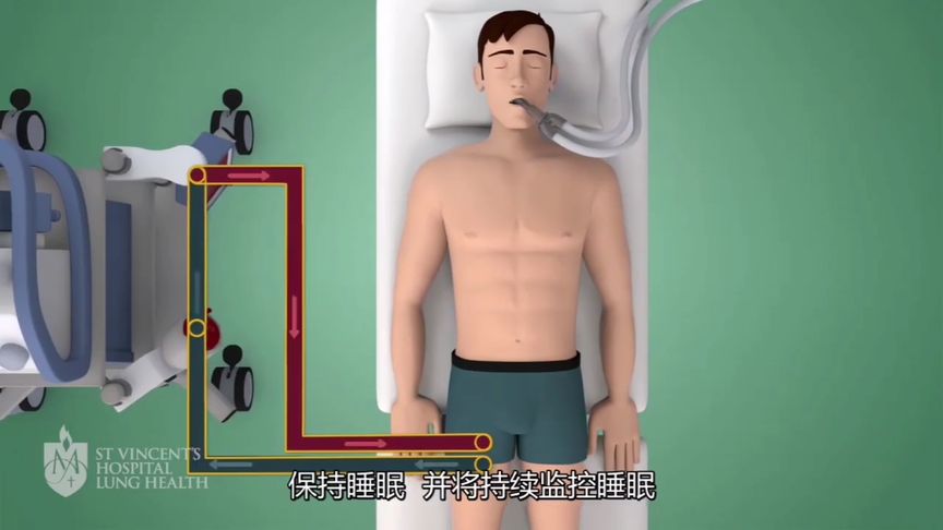 重症肺炎患者的救命神器ECMO(人工肺),1分钟了解一下