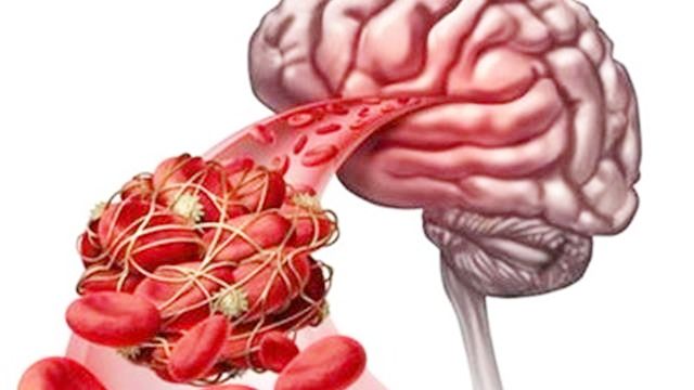 脑血管堵塞的症状是什么?医生:会出现临床上典型的“三偏症”