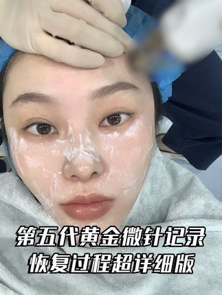 传说中的痛感地狱级项目效果居然这样…#皮肤管理 #黄金微针 #皮肤...