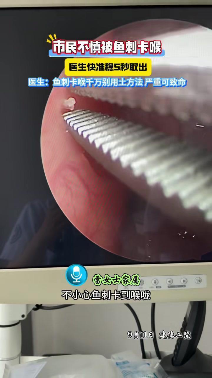 市民不慎被鱼刺卡喉,痛了好多天才前往医院就医。医生提醒:鱼刺卡喉,...