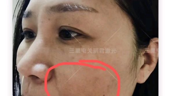 黄褐斑三年前后对比 黄褐斑要根据每个人的皮肤薄厚度斑的情况,要...