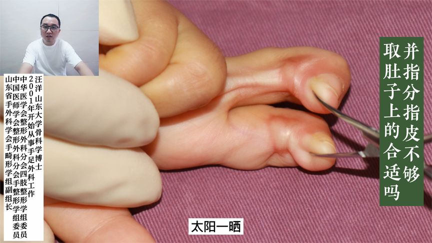 取肚子上的皮植皮合适吗