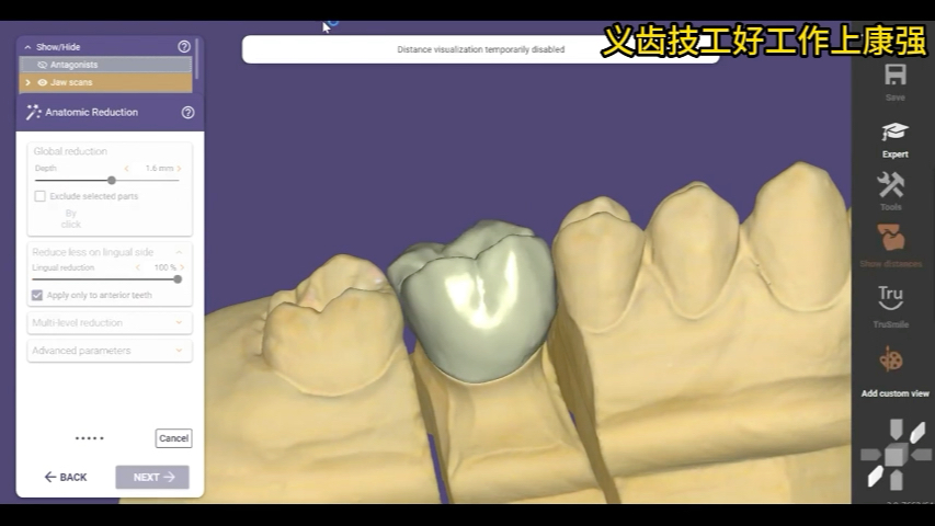 上颌6半全冠EXO设计by Easy Exocad Designs#EXO#牙匠之家