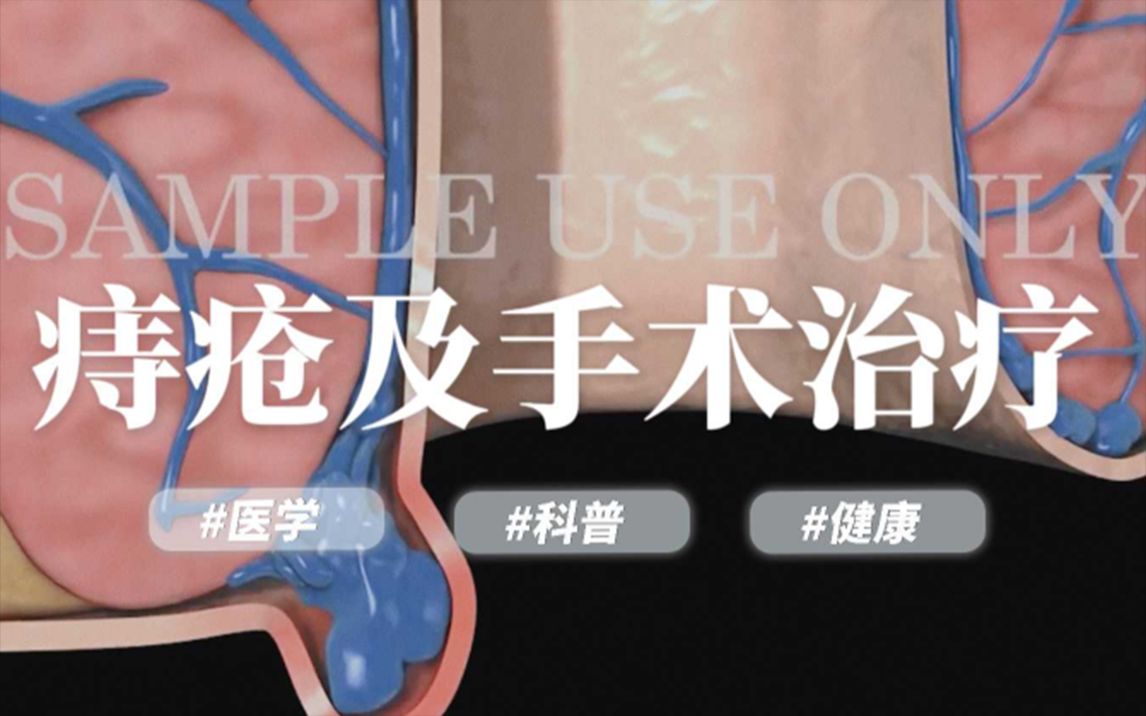 【手术一问】带大家了解痔疮及其手术治疗